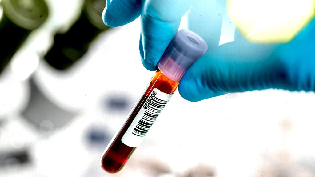 New test may quickly detect early-stage lung cancer - Pakistan Observer