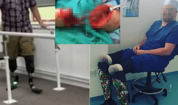 Surgeon claims half million from Insurance after cutting off own legs ...